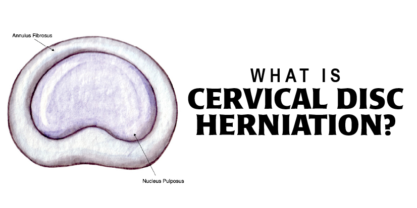 What is Cervical Disc Herniation?